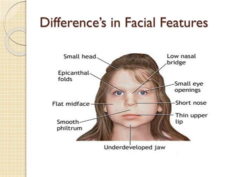 Ppt Fetal Alcohol Syndrome Powerpoint Presentation Free Download