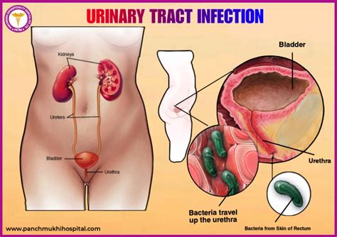 Viral Urinary Tract Infection