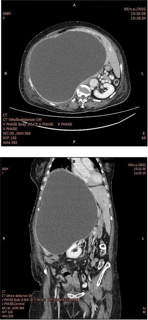Whole Abdomen Enhanced Ct Showed A Huge Hepatic Cyst Occupying The Download Scientific Diagram