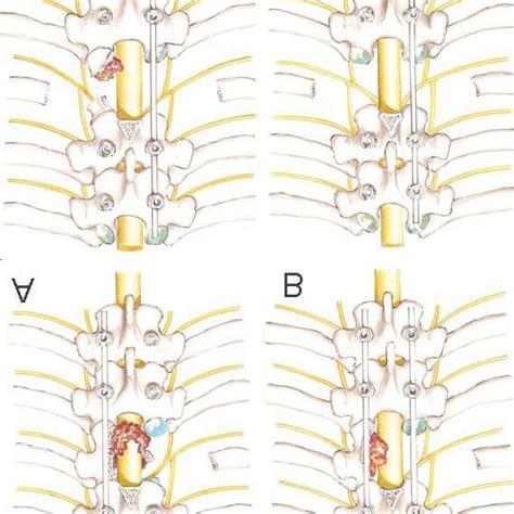 A Open Thymectomy Transcervical Approach Blue Line Transsternal