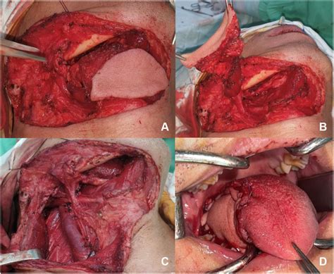 Tongue Reconstruction After Hemiglossectomy Due To Cancer By Submental