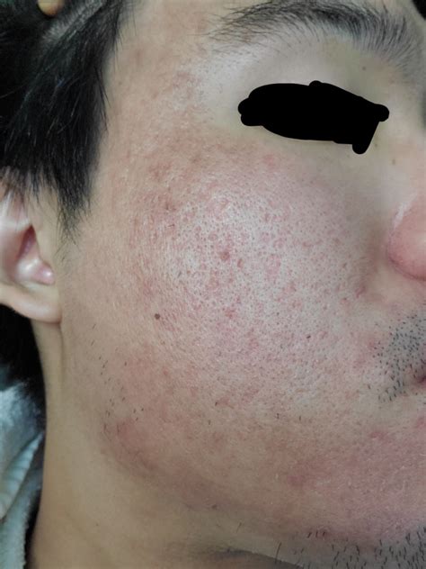 Recommended Treatments For Scar And Redness Scar Treatments Acne Org Forum