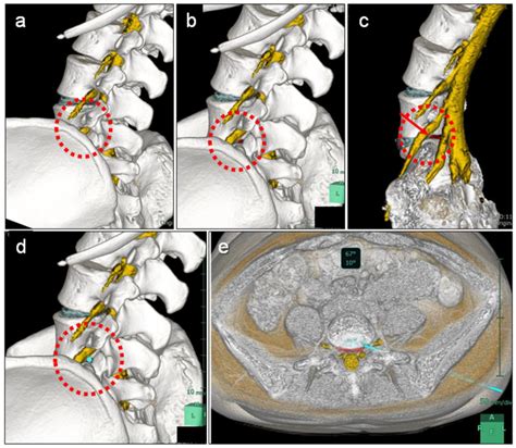 What Is Full Endoscopic Lumbar Discectomy At Will Jarman Blog