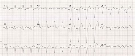 Left Bundle Branch Block New Health Advisor