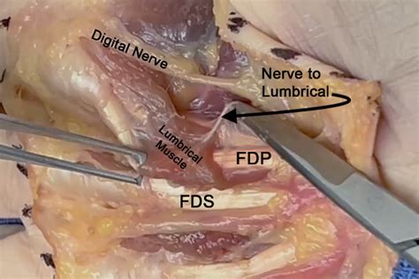 Lumbrical Muscle Anatomy Section 8 Anatomic Structures At Risk
