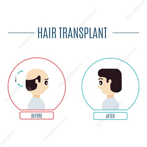 Hair Transplantation Conceptual Illustration Stock Image F0415830