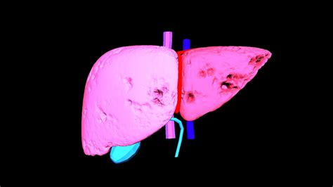 3d Models Of Liver Disease Bundle 6 Pack By Azekapeka