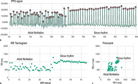 Photoplethysmogram Ppg Recording A 60 S Ppg Signal Measured At The