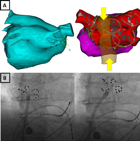 A Left Computer Tomography Generated Segmentation Of The Left Atrium Download Scientific
