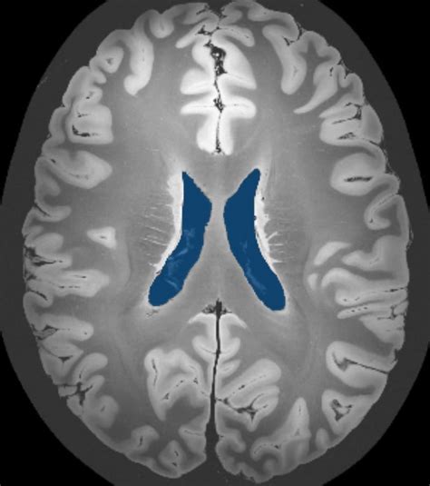 Lateral Ventricles 50 Mri Cases Medseg