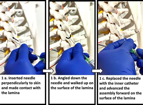 Retrolaminar Continuous Nerve Block Catheter For Multiple Ri Aanda