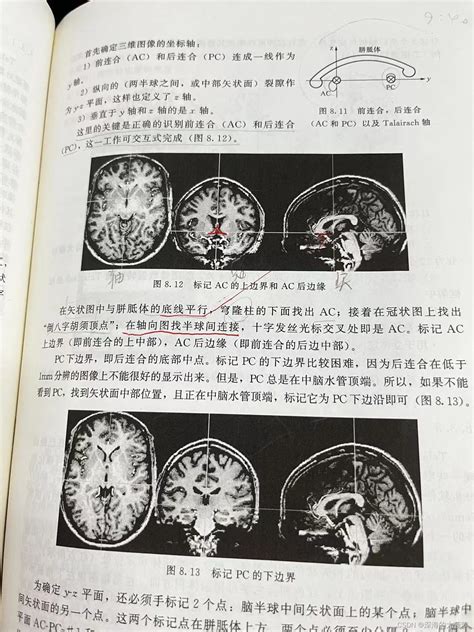 功能像spm手动矫正 csdn博客