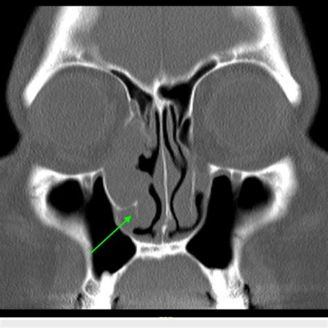 Mri Showing Recurrent Tumor Extending From The Frontoethmoidal Recess