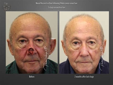 Skin Cancer Reconstruction Case 4773 New Orleans Premier Center For Aesthetics And Plastic Surgery