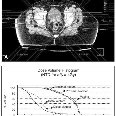 A Radiation Isodose Curve Distribution Using A Six Field Conformal Download Scientific Diagram