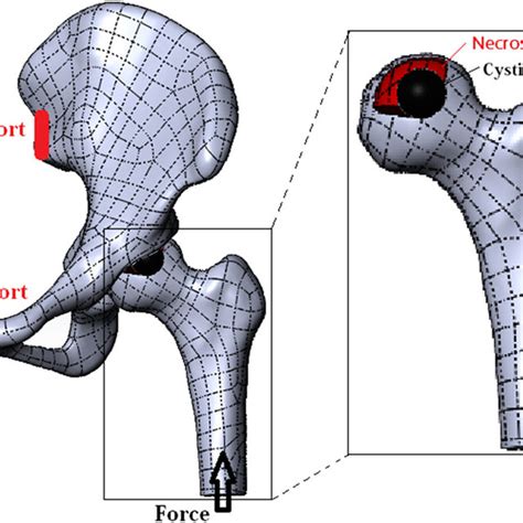Pdf Effect Of Femoral Head Necrosis Cystic Area On Femoral Head