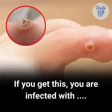 6 Types Of Warts Signs Symptoms Home Remedies And Treatment