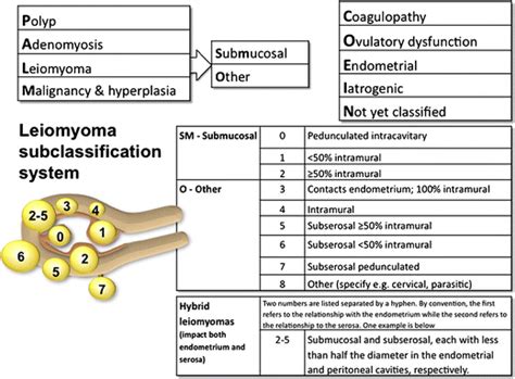 Leiomyoma Subclassification System Republished With Permission From