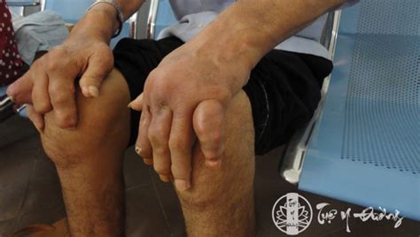 BỆNH GOUT LÀ GÌ NGUYÊN NHÂN TRIỆU CHỨNG Tuệ Y Đường