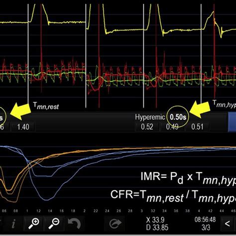 Coronary Physiology Assessment Using The Thermodilution Technique Download Scientific Diagram