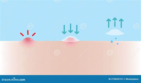 Acne Pimple Patch For Papule Vector Illustration On Blue Background 279603151