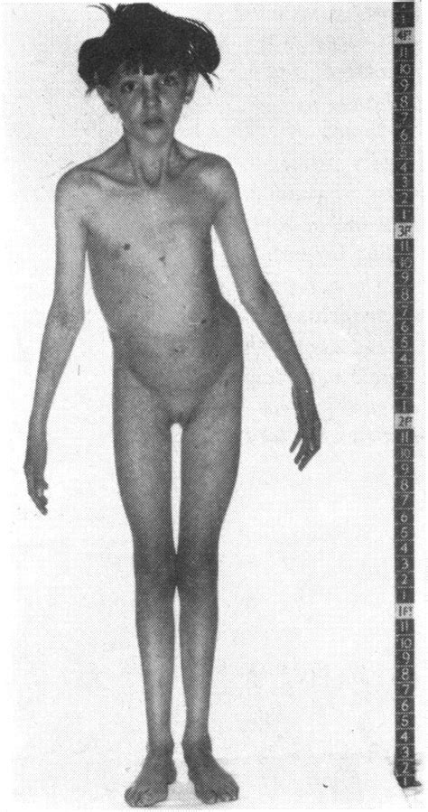 Physique Of Case At Age I Years Showing No Secondary Sex Download Scientific Diagram