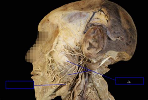 Practical 3 Lab 6 Muscles Of Mastication Temporal And Infratemporal Fossa Flashcards Quizlet
