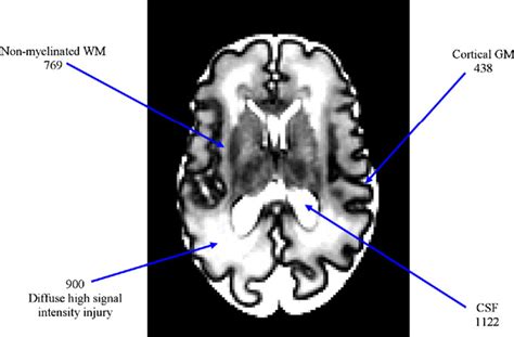 Figure 1 From Automatic Segmentation And Reconstruction Of The Cortex From Neonatal Mri