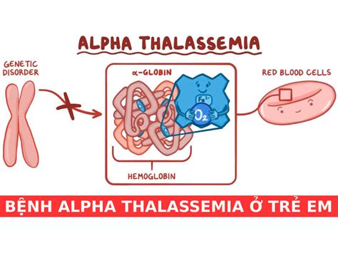 Bệnh Alpha Thalassemia ở Trẻ Em Và Những Hiểu Biết Cơ Bản