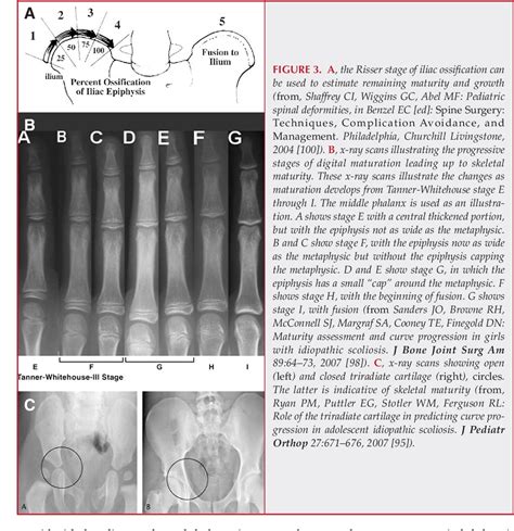 figure 1 from decision making in pediatric spinal deformity semantic