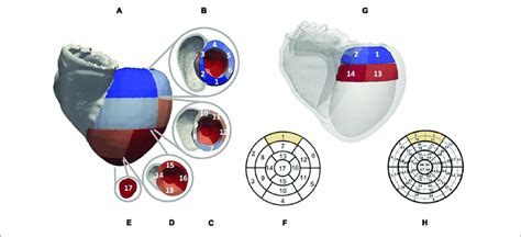 Patient Specific Lv Segment Models Generic Aha 17 Segment Model Is