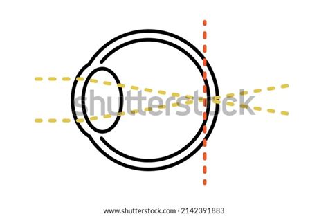 Medical Illustration Visual Acuity Refractive Error Stock Vector Royalty Free