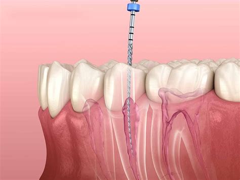 Root Canal Treatment Rainbow Dental Clinic
