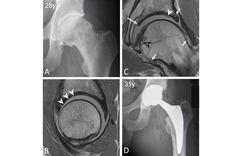 A 28 Year Old Man With Cam Fai B Preoperative Traction Mr Arthrogram