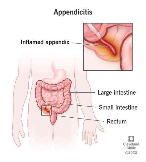 Appendicitis MirrorLog