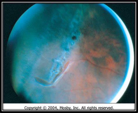 Peripheral Retinal Evaluation Flashcards Quizlet