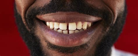 Breakthrough On The Horizon Tooth Regrowth Treatment Shows Promise