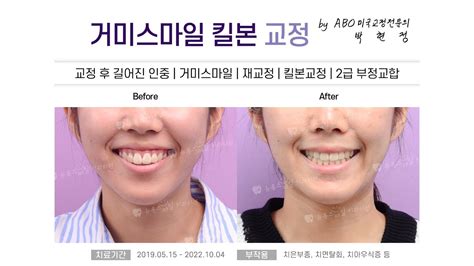 거미스마일 킬본교정교정 후 길어진 인중거미스마일재교정킬본교정2급부정교합 Banda 부산재교정치과 해운대좌동 뉴욕