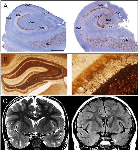 Medial Temporal Lobe Epilepsy