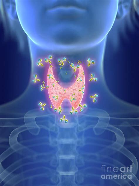 Illustration Of Autoimmune Thyroid Disease Photograph By Sebastian Kaulitzki Science Photo Library