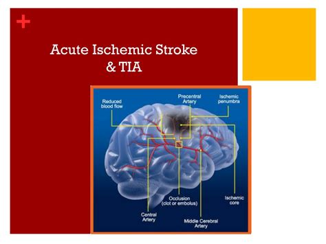 Ppt Comprehensive Guide To Acute Ischemic Stroke And Tia Powerpoint