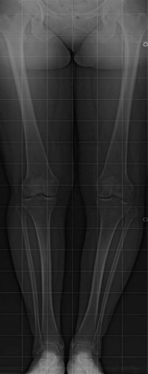 Weight Bearing Long Standing Ap Radiograph Varus Malalignment Of The