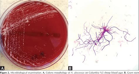 Figure 1 From Pulmonary Nocardiosis Caused By Nocardia Abscessus