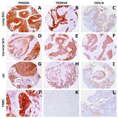 Macroscopy And Histology Of The Synchronous Collision Tumor Consisting Download Scientific