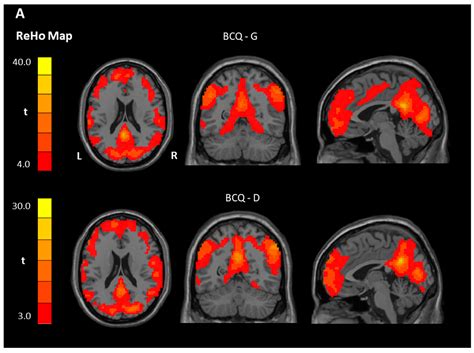 Brain Electrical Activity Mapping Beam The Best Picture Of Beam
