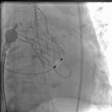 双管齐下｜中国医大一院瓣膜介入团队成功完成经导管主动脉瓣置换术（tavr）经皮二尖瓣球囊扩张成形术（pbmv）一站式手术 严道医声网
