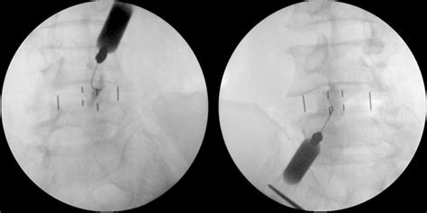 The Journal Of Bone And Joint Surgery Inc On Linkedin Intraoperative Facet Joint Block