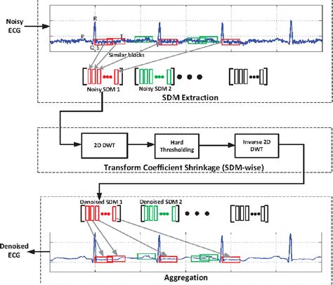 Figure 1 From Electrocardiogram Signal Denoising Using Non Local Wavelet Transform Domain