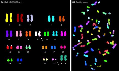 Sickle Cell Anemia Karyotype