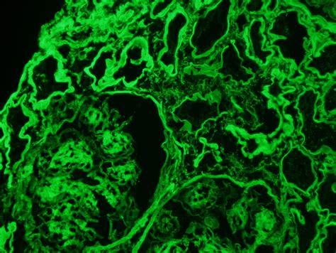 Pathology Outlines Kappa And Lambda Light Chains